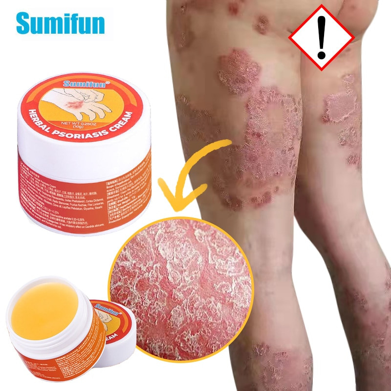 Herbal Psoriasis Cream Dermatitis Eczematoid Treatment Antibacterial ...