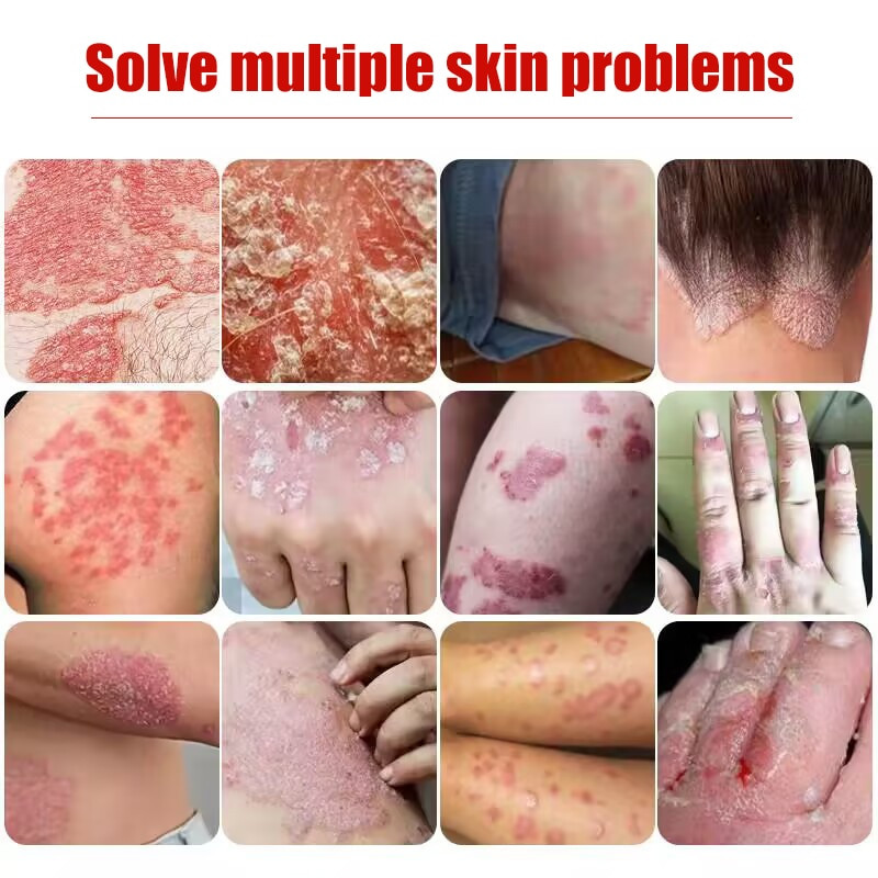 Herbal Psoriasis Cream Dermatitis Eczematoid Treatment Antibacterial ...