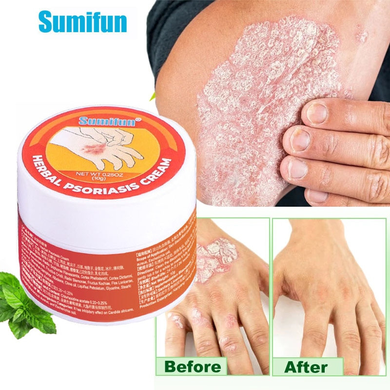 Herbal Psoriasis Cream Dermatitis Eczematoid Treatment Antibacterial ...